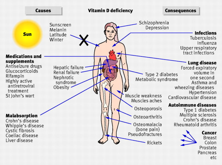 6 Symptoms Of Vitamin D Deficiency That You Might Ignore - Times Lifestyle